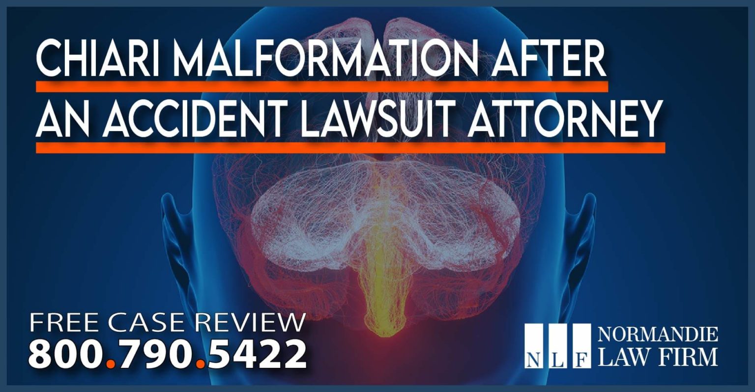 Chiari Malformation after an Accident Lawsuit Attorney