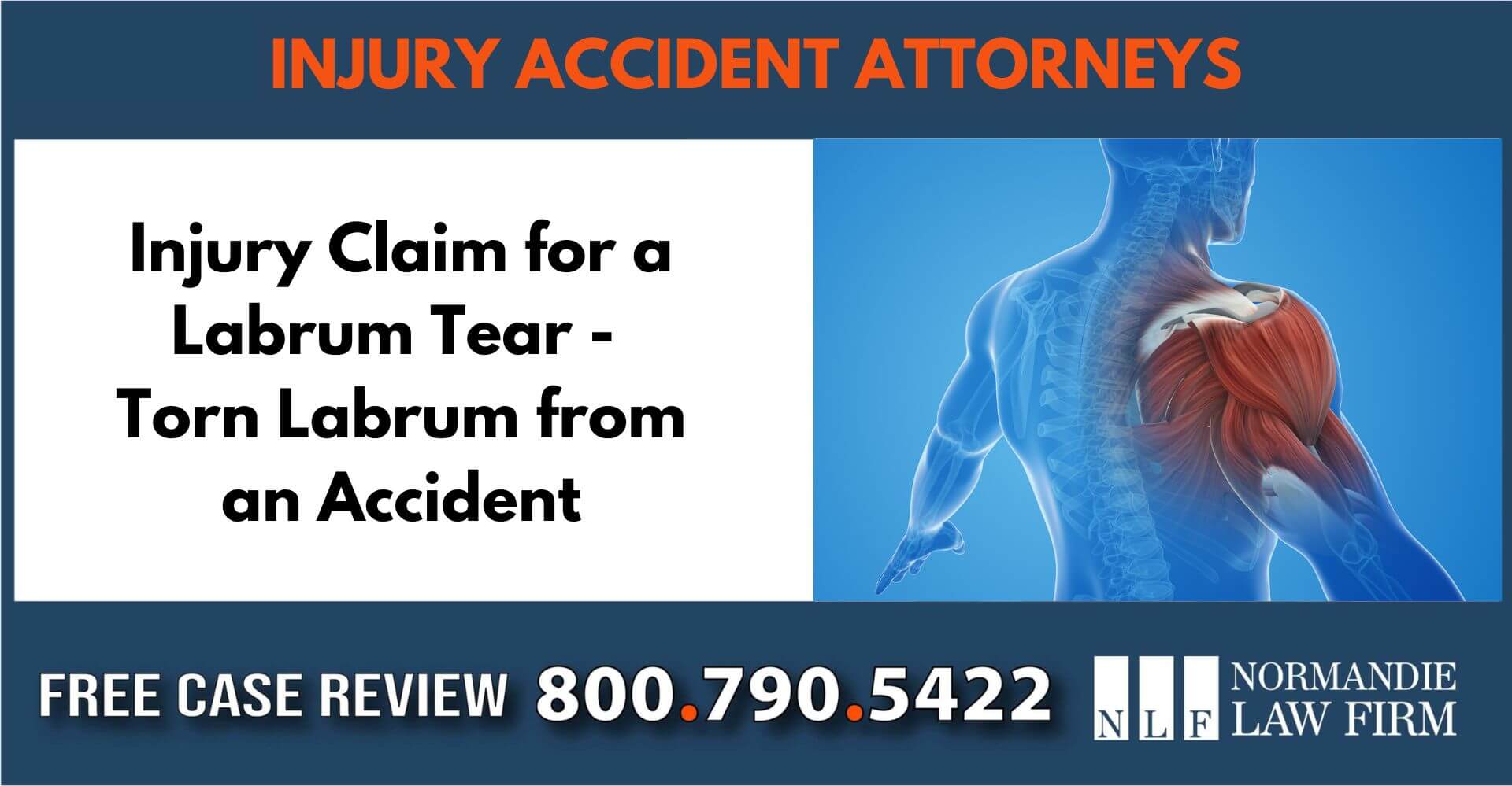 Normandie Law Firm Injury Claim for a Labrum Tear – Torn Labrum from an ...